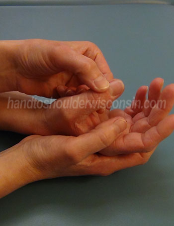 Hand to Shoulder Center of Wisconsin | Scaphoid Fracture